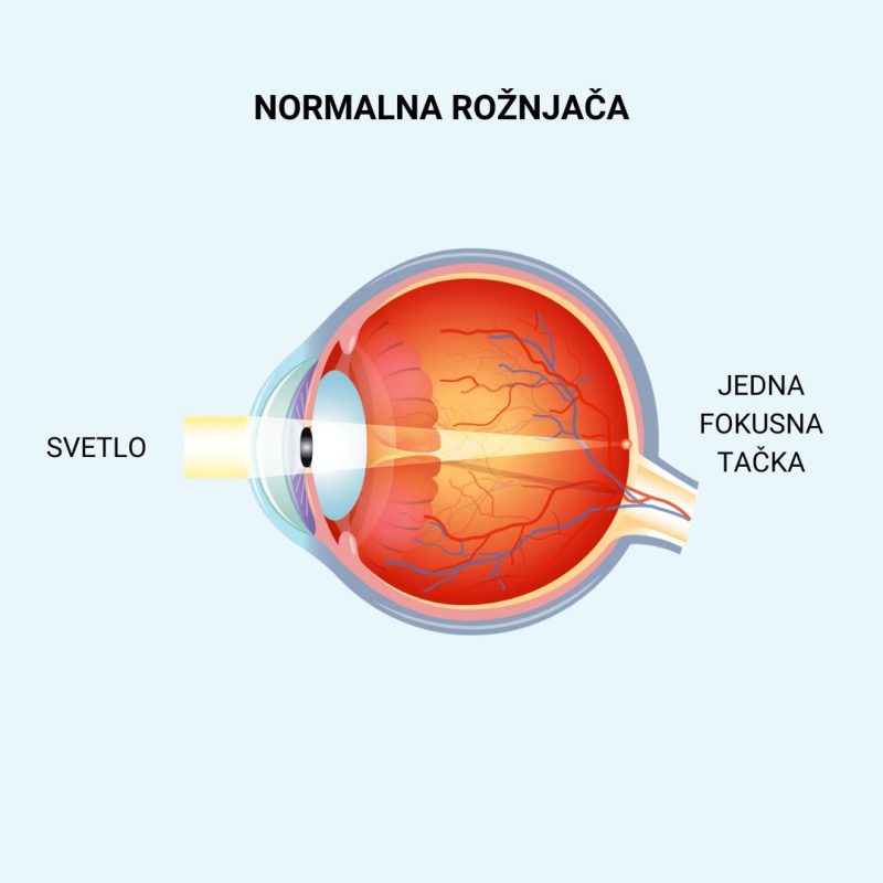Astigmatizam oka ili cilindrična dioptrija | Šta je to?