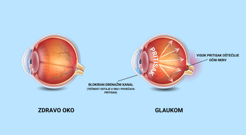 Glaukom - vrste, simptomi i lečenje