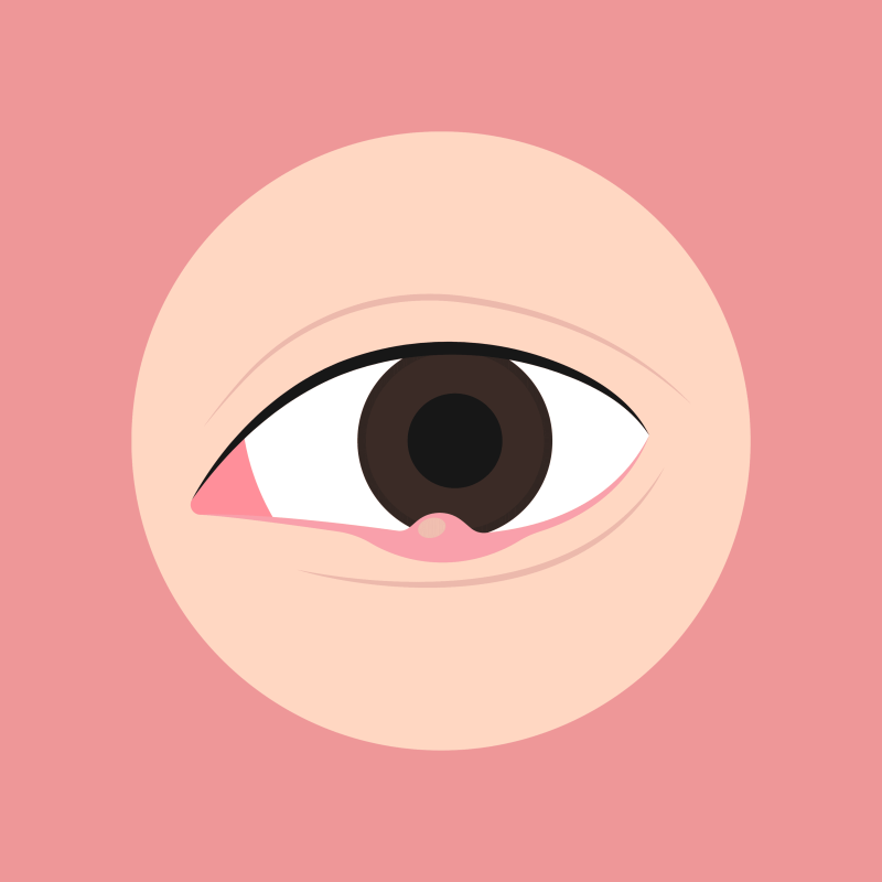 Čmičak na oku - simptomi, uzrok i koji je lek